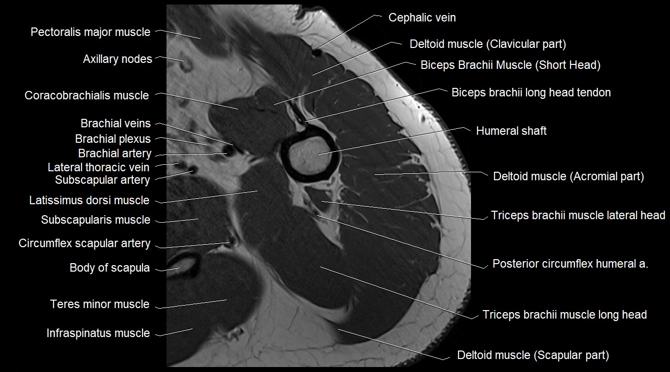 MRI Upper Arm Anatomy – Labeled Axial, Coronal & Sagittal MRI Cross ...