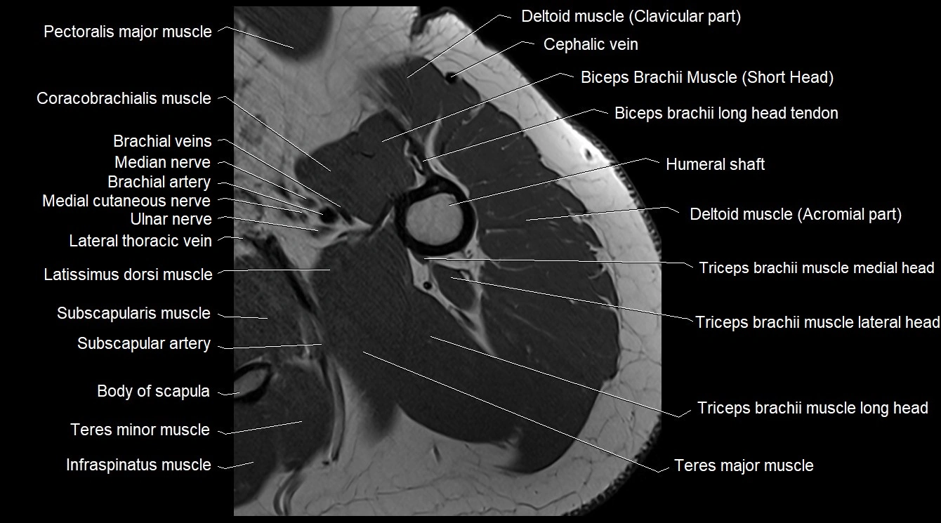 MRI Upper Arm Anatomy – Labeled Axial, Coronal & Sagittal MRI Cross ...