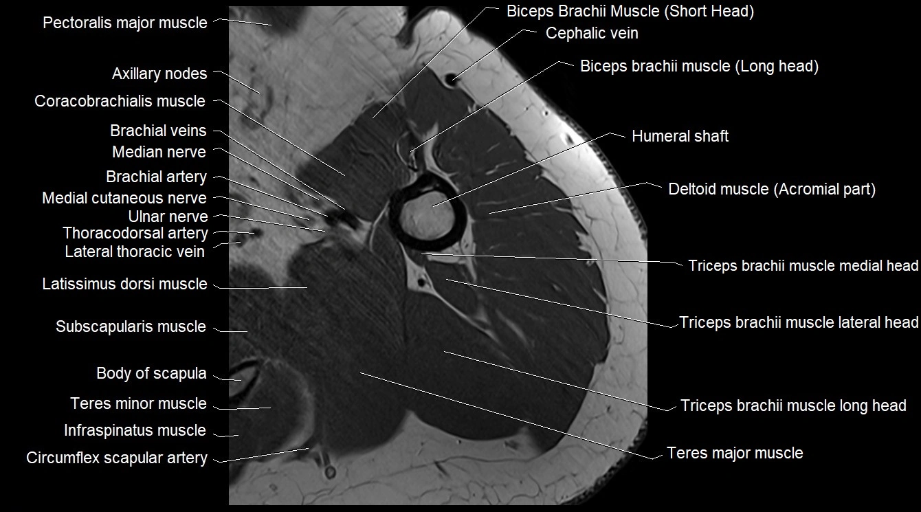 MRI Upper Arm Anatomy – Labeled Axial, Coronal & Sagittal MRI Cross ...