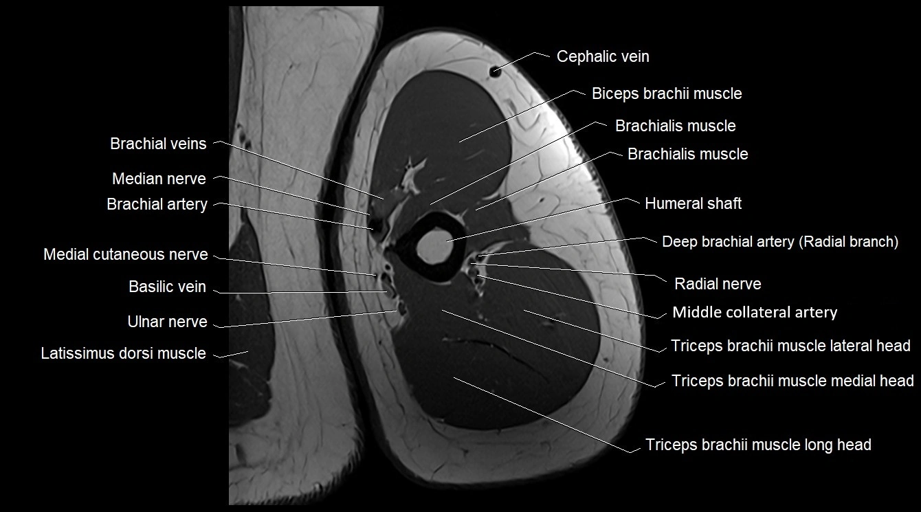 MRI Upper Arm Anatomy – Labeled Axial, Coronal & Sagittal MRI Cross ...