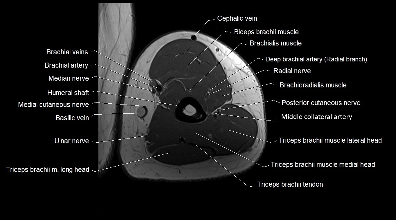 MRI Upper Arm Anatomy – Labeled Axial, Coronal & Sagittal MRI Cross ...