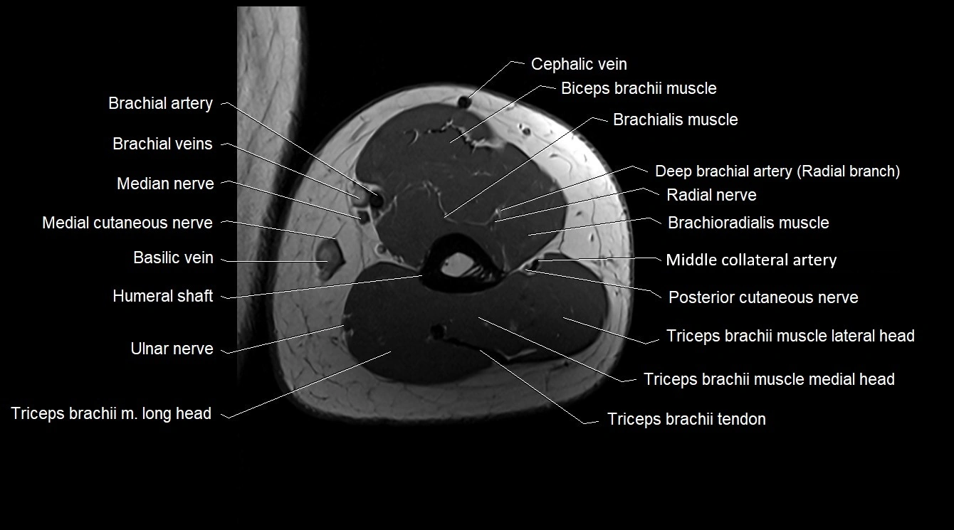 MRI Upper Arm Anatomy – Labeled Axial, Coronal & Sagittal MRI Cross ...