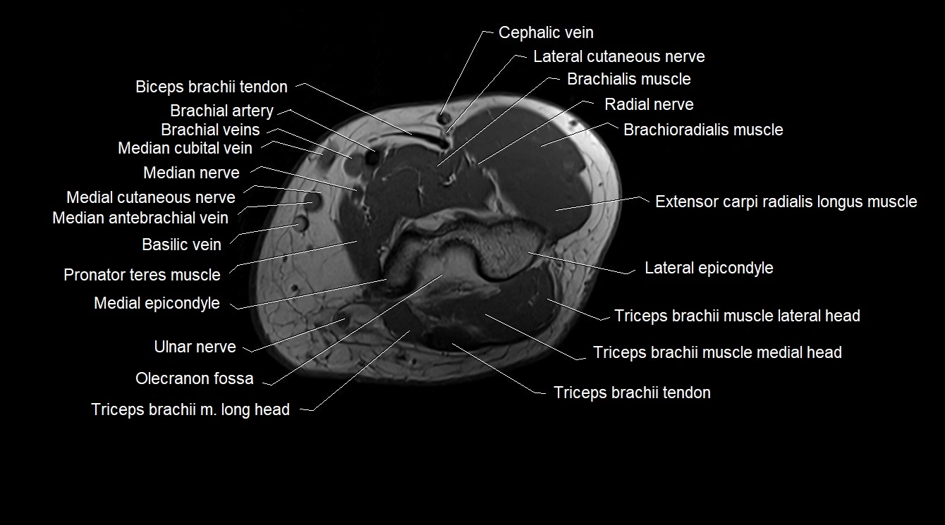 MRI Upper Arm Anatomy – Labeled Axial, Coronal & Sagittal MRI Cross ...