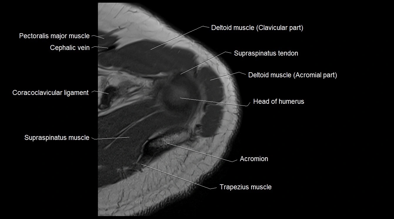 MRI Upper Arm Anatomy – Labeled Axial, Coronal & Sagittal MRI Cross ...