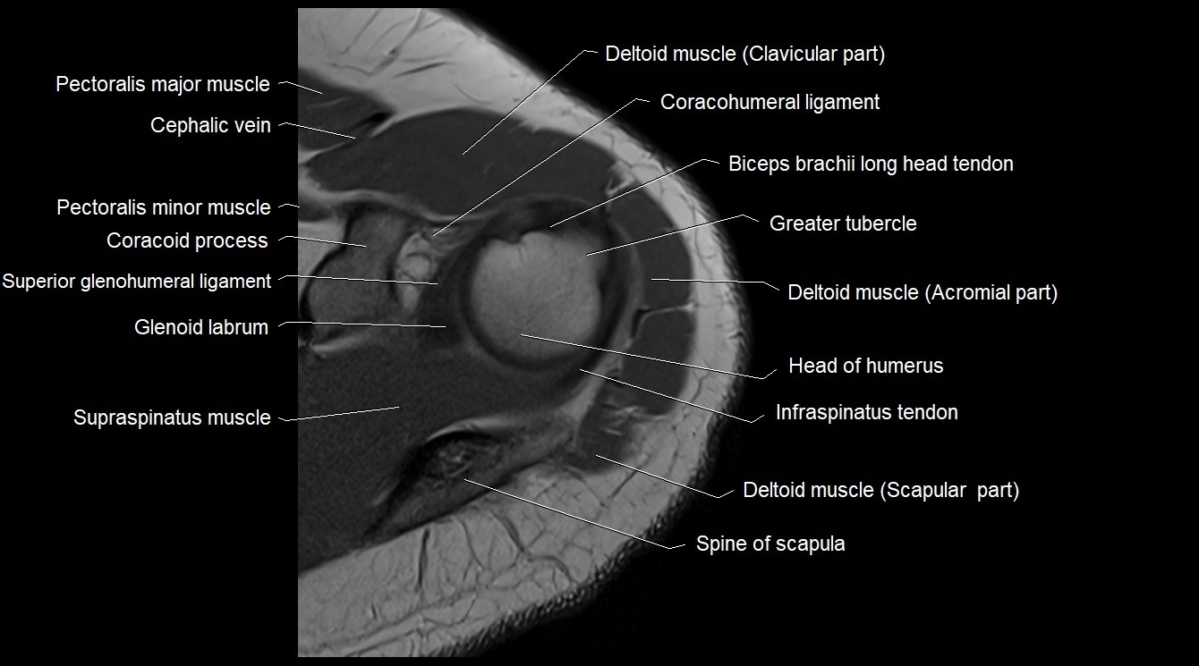 MRI Upper Arm Anatomy – Labeled Axial, Coronal & Sagittal MRI Cross ...