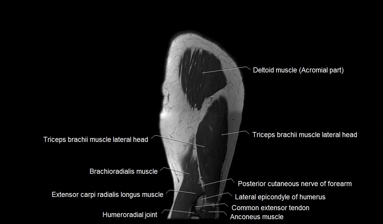 MRI Upper Arm Anatomy – Labeled Axial, Coronal & Sagittal MRI Cross ...