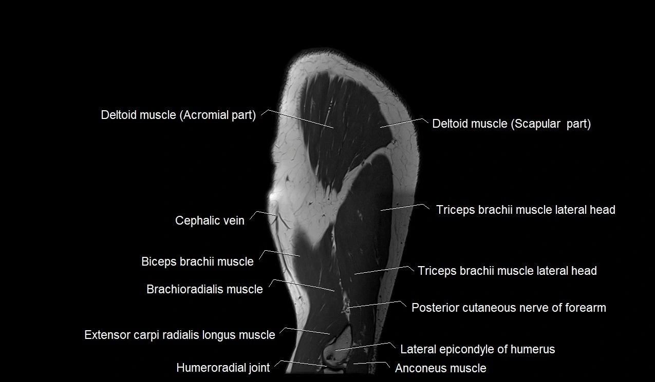 MRI Upper Arm Anatomy – Labeled Axial, Coronal & Sagittal MRI Cross ...