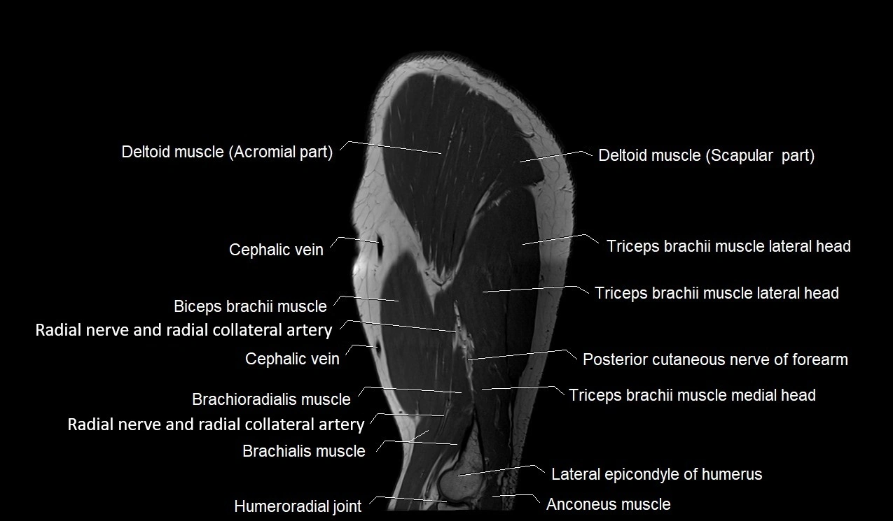 MRI Upper Arm Anatomy – Labeled Axial, Coronal & Sagittal MRI Cross ...
