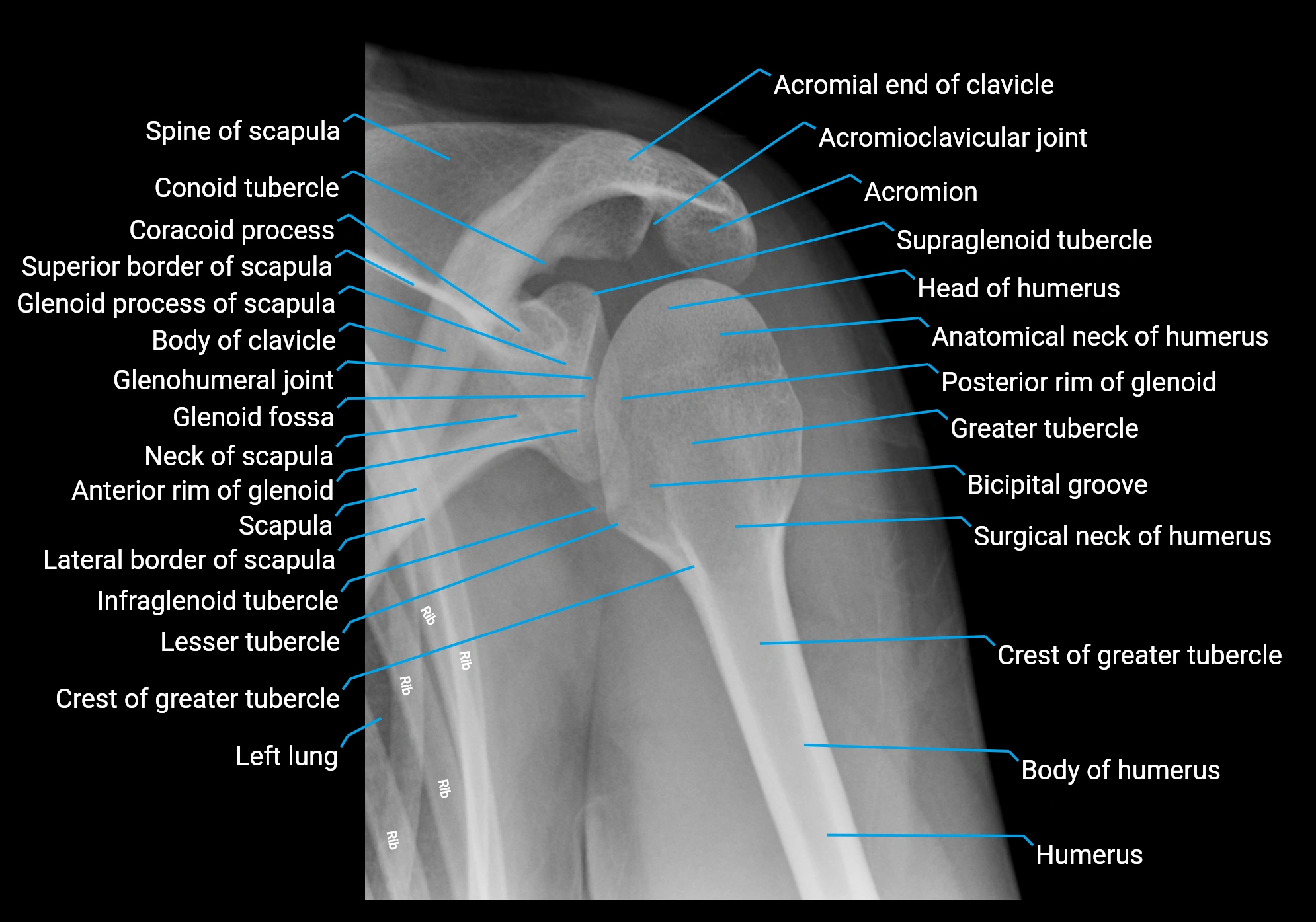 Shoulder X-Ray Anatomy – AP & Lateral Views | Labeled Normal Images