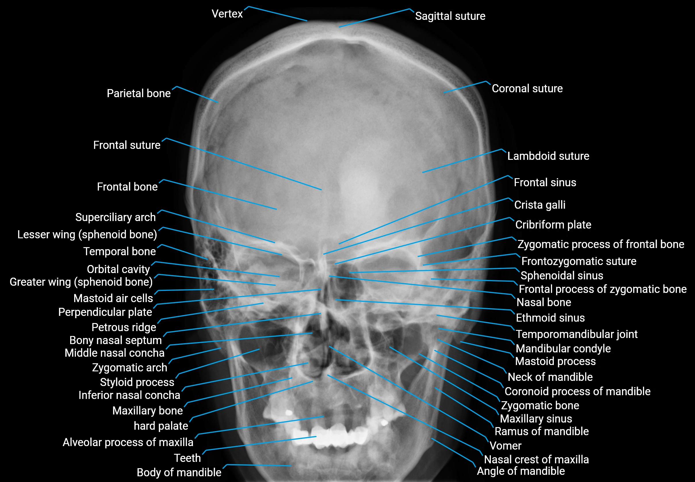 X-ray Skull Anatomy – Normal AP & Lateral X-ray with Labeled Bones