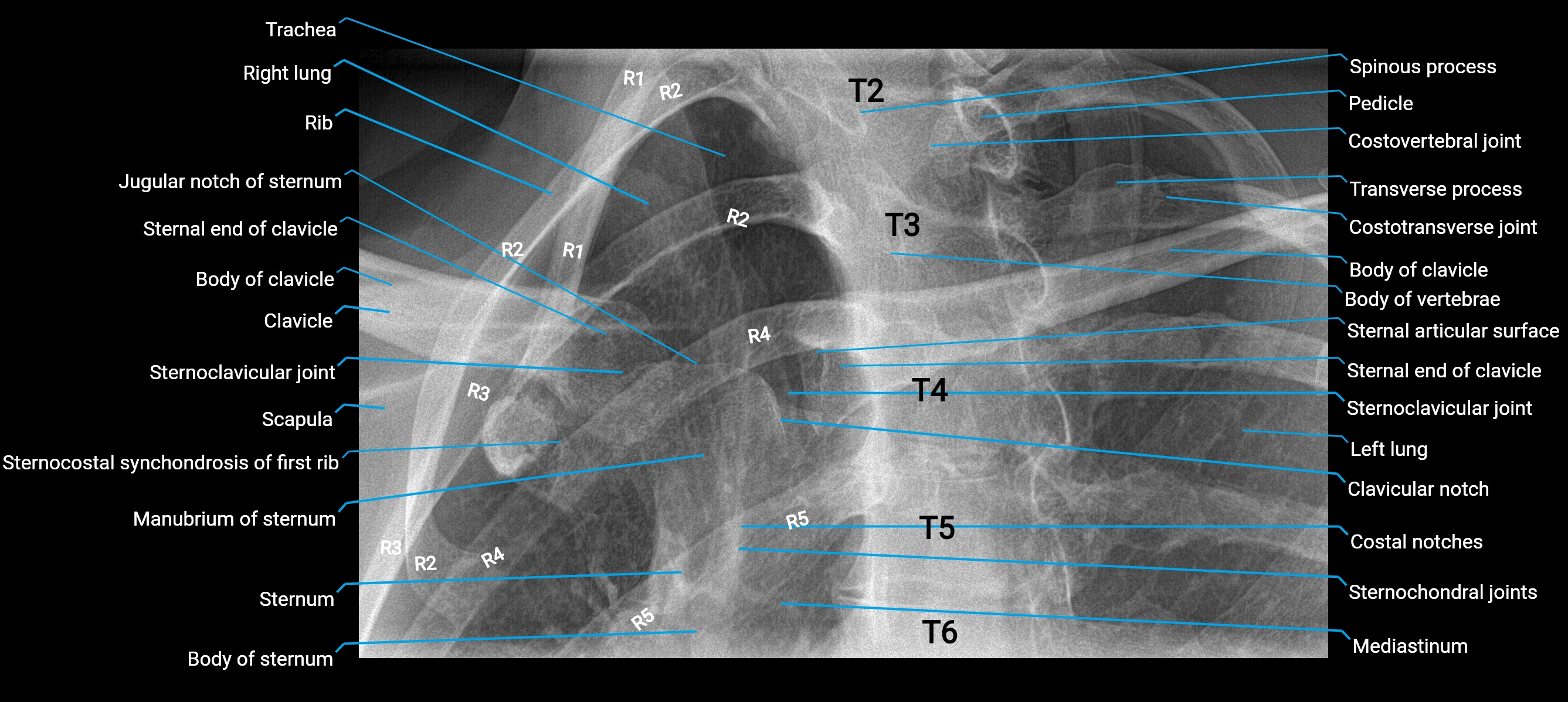Sternoclavicular Joint X-Ray Anatomy: PA, Right & Left Oblique Views
